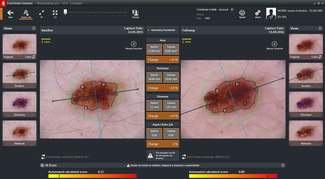 Wideodermatoskopia - komputerowe badanie znamion