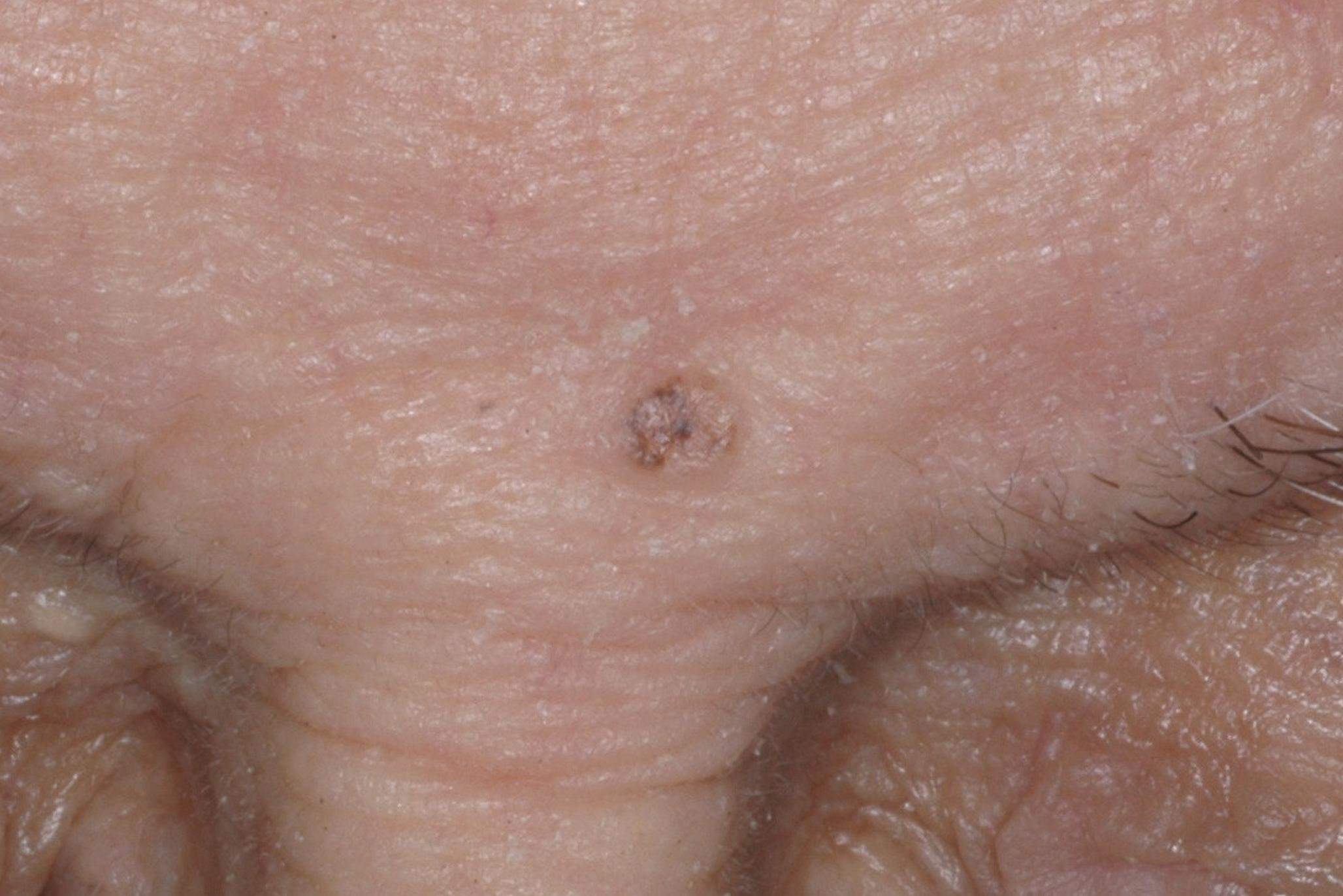 Rak podstawnokomórkowy skóry (BCC) – objawy, diagnostyka, leczenie