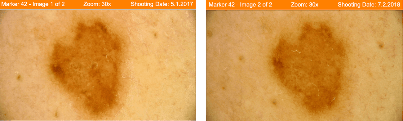 Wideodermatoskopia - komputerowe badanie znamion