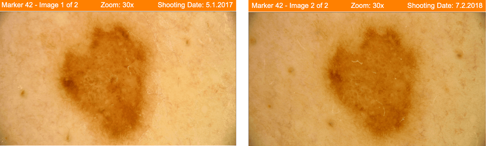 Wideodermatoskopia - komputerowe badanie znamion