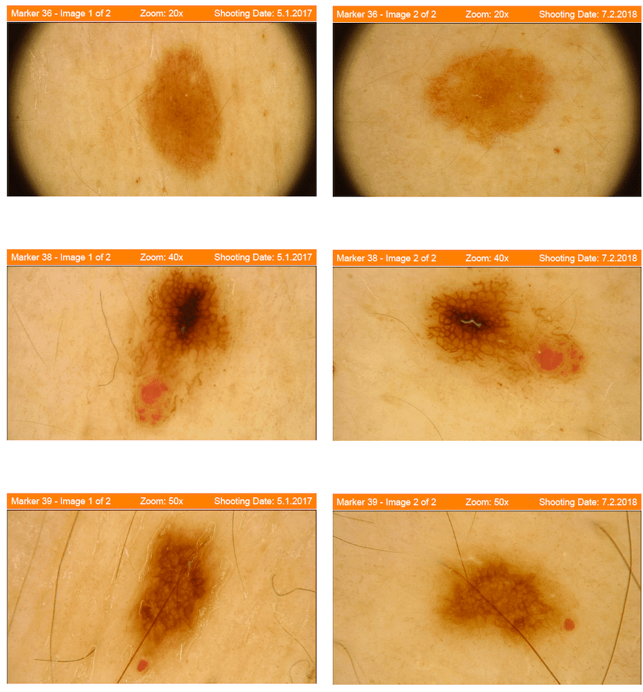 Wideodermatoskopia - komputerowe badanie znamion