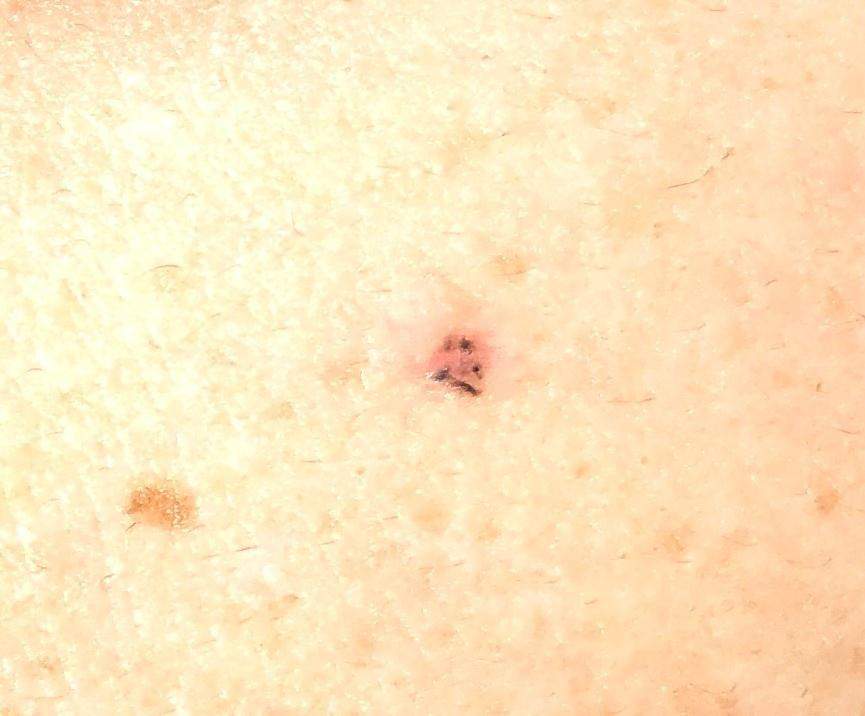 Rak podstawnokomórkowy skóry (BCC) – objawy, diagnostyka, leczenie